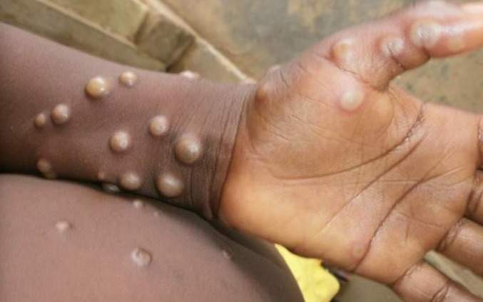 Mpox health emergency raises concerns on an international level amid ...